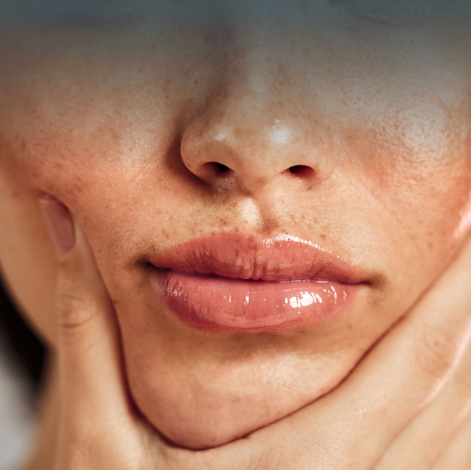 Dermal Fillers in Mishawaka, IN – Enhance Your Natural Beauty